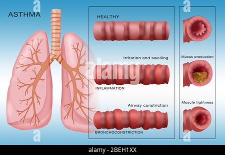 Asthma diagram as a healthy and unhealthy bronchial tube with a ...