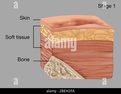 Progression of Pressure Sore Stock Photo - Alamy