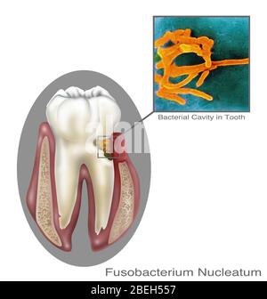 Oral Infection of Fusobacterium Nucleatum Stock Photo - Alamy