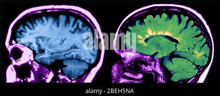 MRI showing multiple sclerosis in a 42 year old woman Stock Photo ...