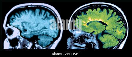 MRI of Normal Brain and Multiple Sclerosis Lesions Stock Photo - Alamy