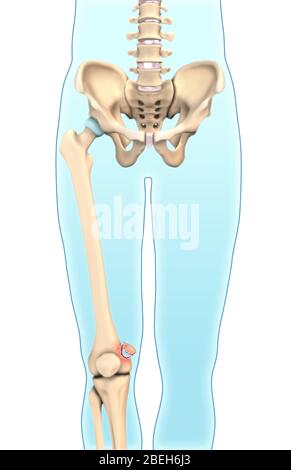 Avulsion Bone Fracture, Illustration Stock Photo - Alamy
