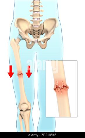 Impacted Bone Fracture, Illustration Stock Photo - Alamy