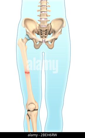 Transverse Bone Fracture, Illustration Stock Photo - Alamy