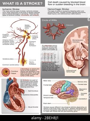 Ischemic & Hemorrhagic Stroke, Illustration Stock Photo - Alamy