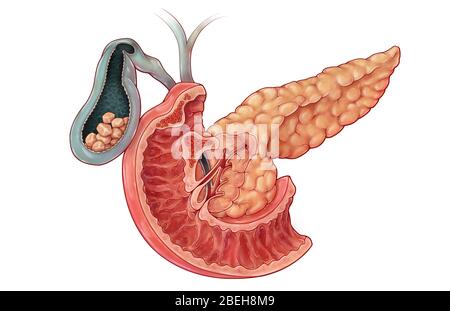 GALLSTONE, ANATOMY Stock Photo: 49167990 - Alamy