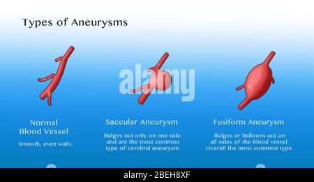 Types of Aneurysms Stock Photo - Alamy