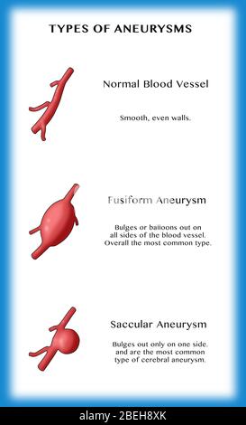 Types of Aneurysms Stock Photo - Alamy