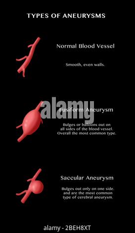 Infographic comparing a normal blood vessel (left) with two types of ...