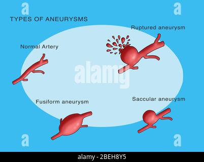 Types of Aneurysms Stock Photo - Alamy
