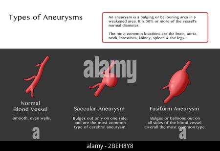 Types of Aneurysms Stock Photo - Alamy