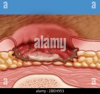 Stage 3 pressure sore, illustration Stock Photo - Alamy