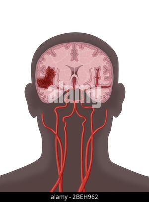 BRAIN HEMORRHAGE, ILLUSTRATION Stock Photo - Alamy