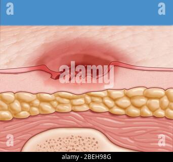 Stage 4 pressure sore, illustration Stock Photo - Alamy