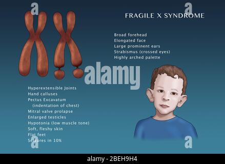Fragile X Syndrome, Illustration Stock Photo - Alamy