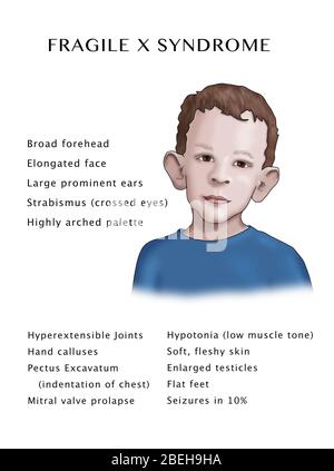 Fragile X Syndrome Stock Photo - Alamy