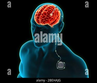 Deep Brain Stimulation, Illustration Stock Photo - Alamy