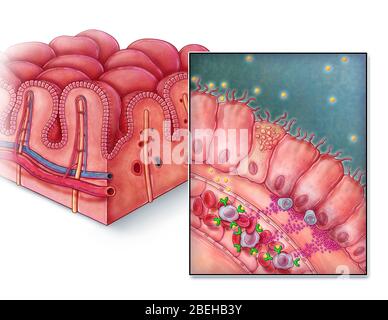 Celiac or coeliac disease anatomy medical concept with normal villi and ...