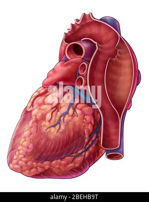 Aortic Dissection, Illustration Stock Photo - Alamy