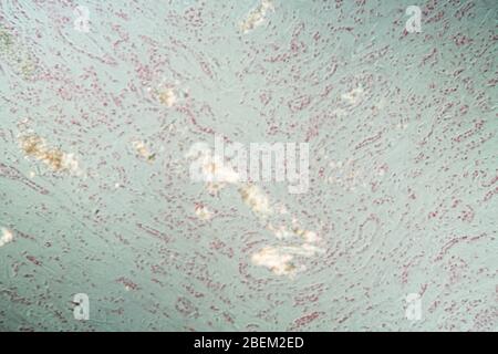 Gout crystals deposits in the kidney tissue under the microscope 100x ...