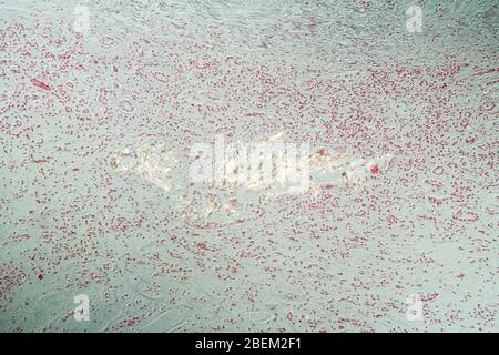 Gout crystals deposits in the kidney tissue under the microscope 100x ...