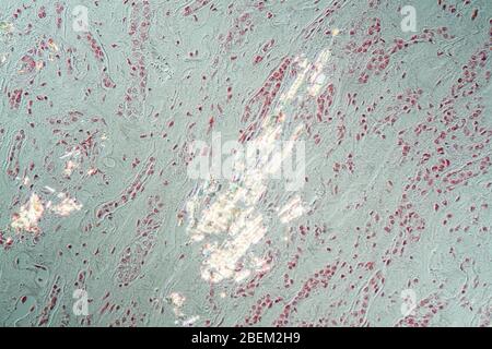 Gout crystals deposits in the kidney tissue under the microscope 100x ...