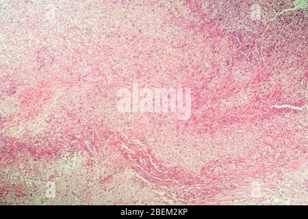 Gallbladder necrosis tissue under the microscope 100x Stock Photo - Alamy