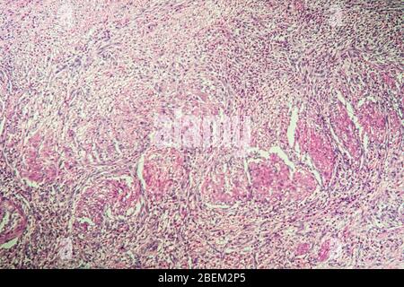 Gallbladder necrosis tissue under the microscope 100x Stock Photo - Alamy