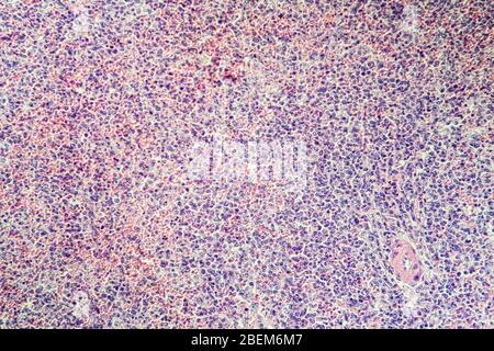 Gas burn of the liver diseased tissue under the microscope 100x Stock ...