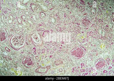 Shrinked kidney diseased tissue under the microscope 100x Stock Photo ...