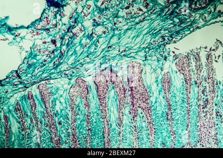 Colon carcinoma Tissue under the microscope 100x Stock Photo - Alamy