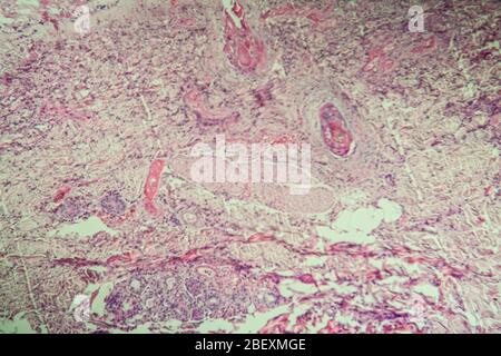 Chickenpox infection tissue under the microscope 100x Stock Photo - Alamy