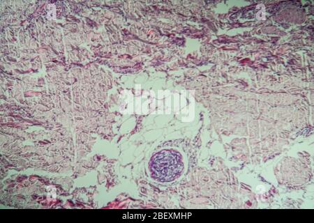 Chickenpox infection tissue under the microscope 100x Stock Photo - Alamy