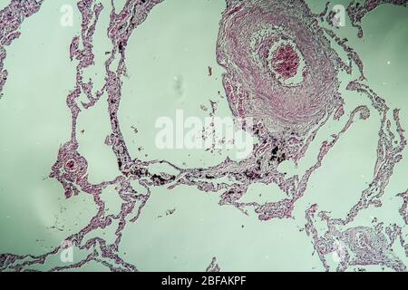 Tissue contaminated with asbestosis 100x Stock Photo - Alamy