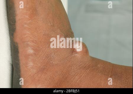 A paitent with a sebaceous cyst on their foot. Sebaceous cysts are ...