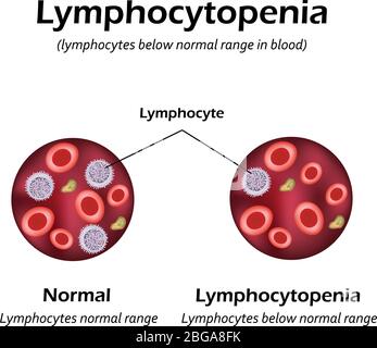 Lymphocytes below the normal range in the blood. Lymphocytopenia ...