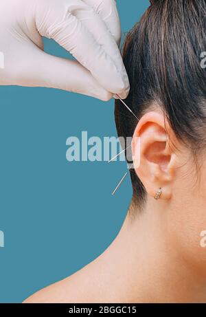 Close-up of acupuncture needles on an ear. Close-up of three ...