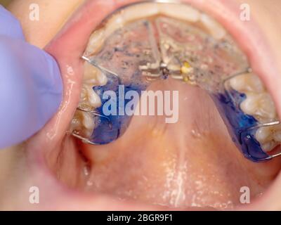 Installation of braces on teeth. Orthodontic dental treatment. Close-up ...