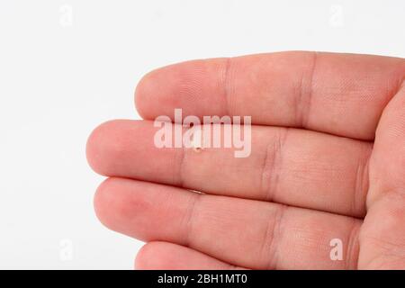 Hand with blister and callus close up Stock Photo - Alamy
