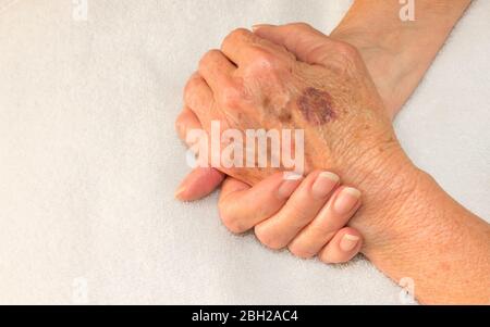 Sun damage. Woman showing the damage sun exposure has done to her skin ...