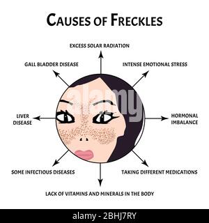 Freckles on the face of the cause. Pigmentation on the skin. A ...