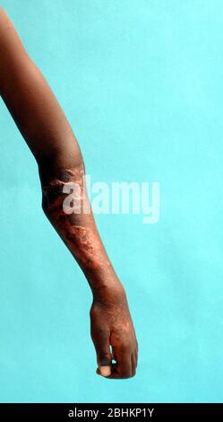 An ischaemic arm of a young teenage boy. Ischaemia is a restriction in ...