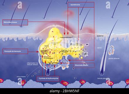 Acne around the hair follicle, sebaceous hypersecretion ...
