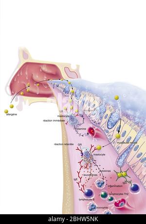 Nasal congestion, detail of nasal mucosa, allergen, allergic reaction ...