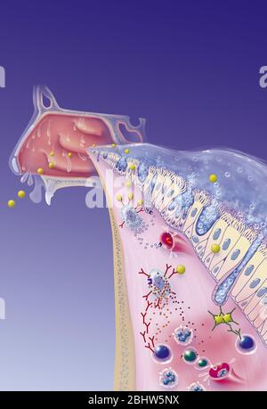 Nasal congestion, detail of nasal mucosa, allergen, allergic reaction ...