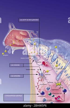 Nasal congestion, detail of nasal mucosa, allergen, allergic reaction ...
