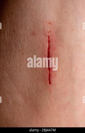Skin lesion, illustration Stock Photo - Alamy