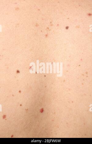 human back skin texture. pimples on skin micro photo. close up photo ...