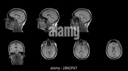 Microcephaly Mri
