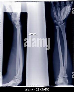 Two arms and wrists, X-ray Stock Photo - Alamy